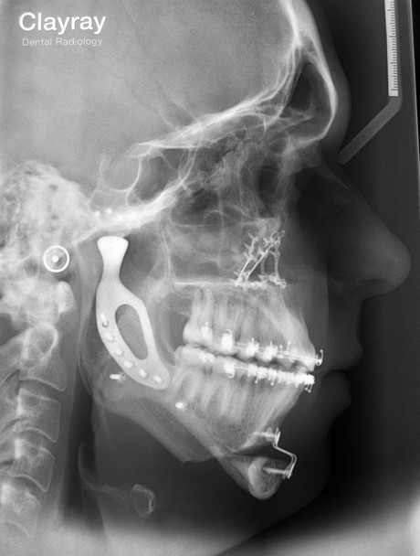 3d Printed Jaw Prosthetic